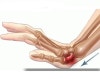 주상골 골절scaphoid Fracture 넘어진 뒤에 엄지 손가락 쪽 손목이 아파요 네이버 블로그